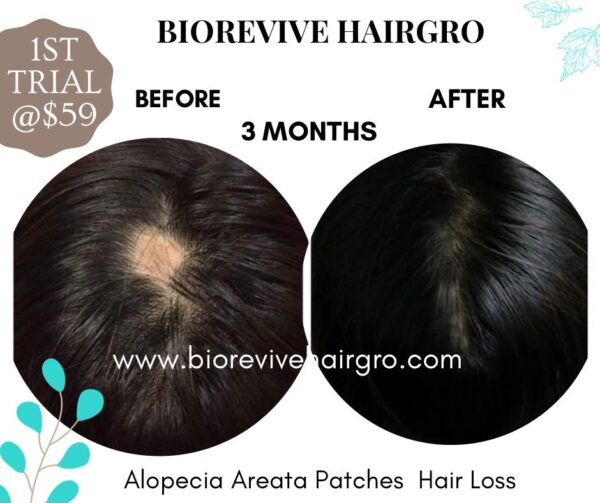 Before and After results of BioRevive HairGro