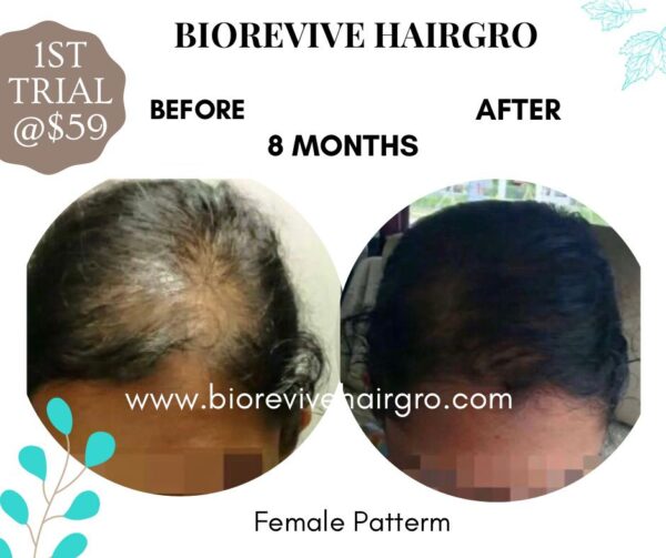 Before and After results of BioRevive HairGro